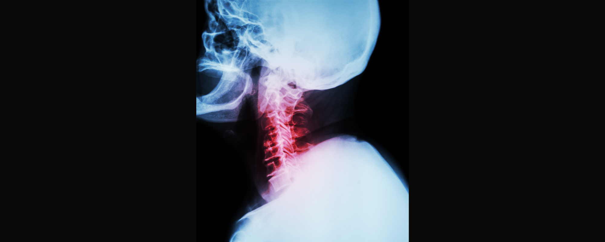 Servikal Spondiloz Nedir? Belirtileri ve Tedavisi- Doç.Dr.Adnan DEMİRCİ